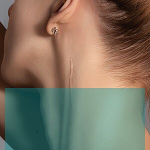 Parches Cicatrizantes | Analizamos todos los reductores de cicatrices