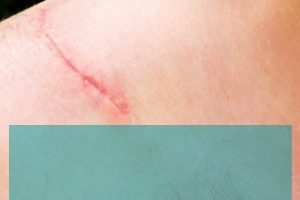 Parches Cicatrizantes Reseñas, opiniones y ofertas